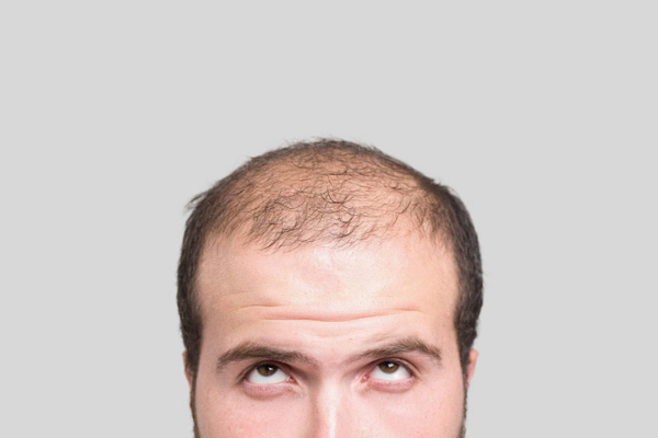 Male Pattern Baldness Stages: Norwood Scale – mars by GHC
