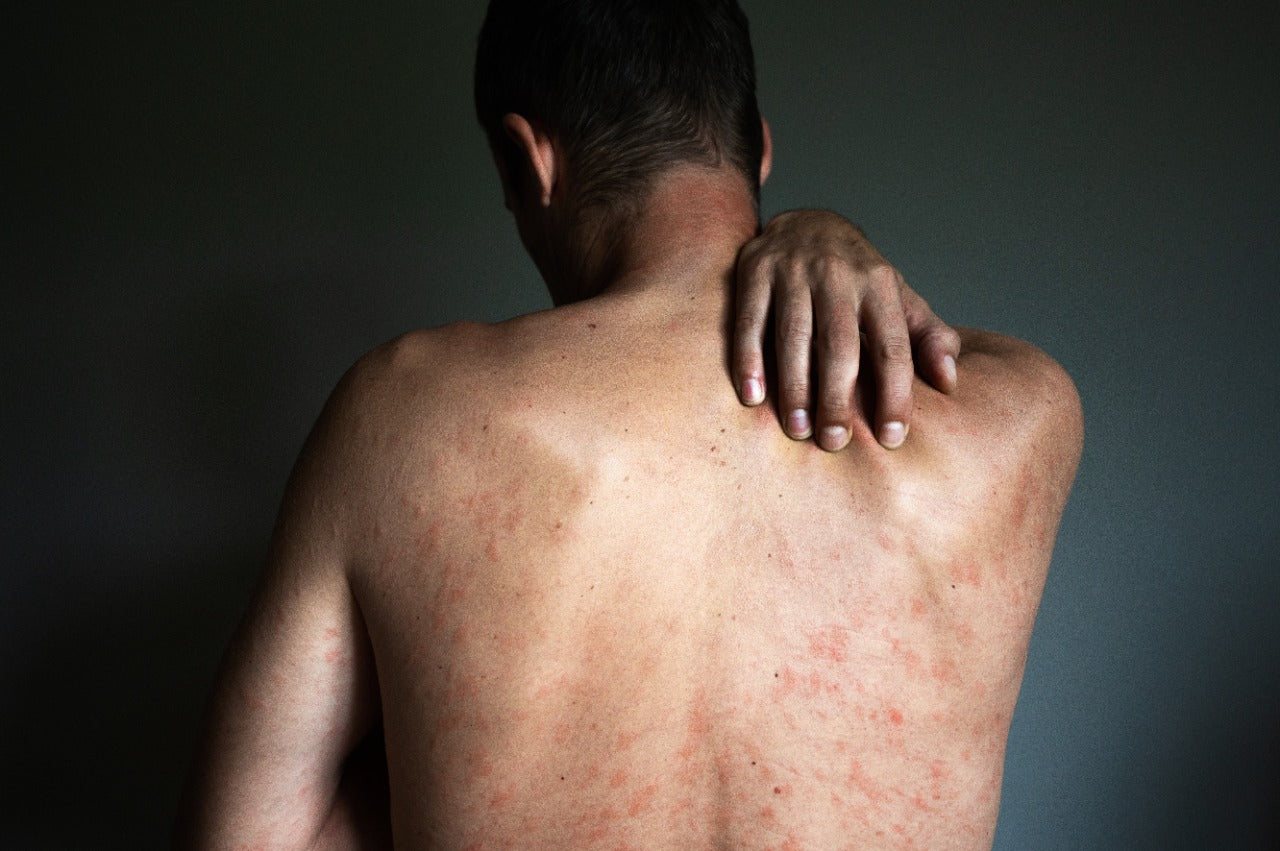 How to remove chicken pox marks naturally? – mars by GHC
