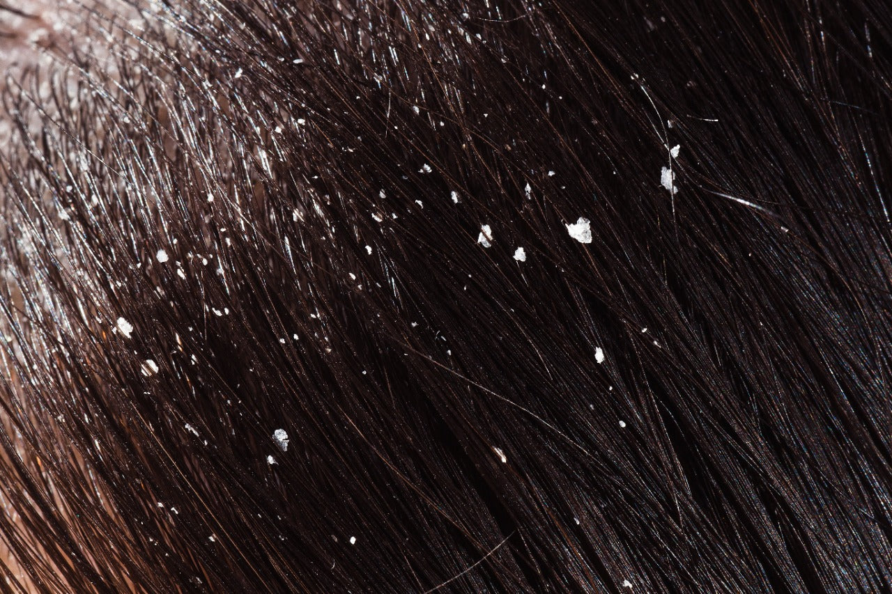 Combatting Dandruff: Choosing the Best Anti-Dandruff Shampoos For A He ...