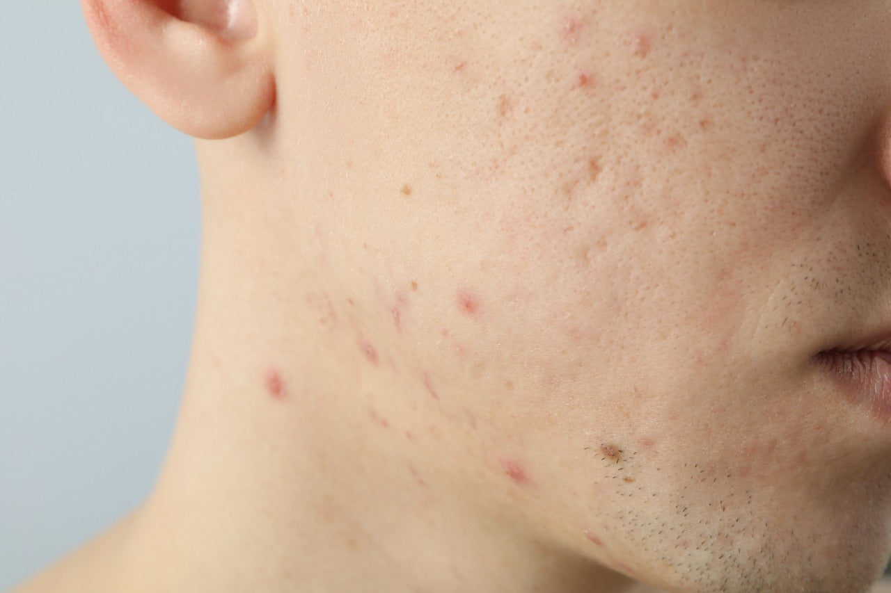 What are blemishes? – mars by GHC